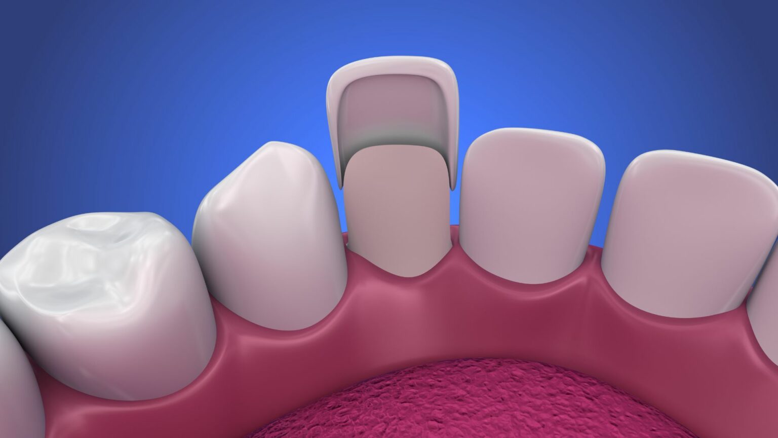 A Step by Step Guide to Fixing Your Chipped Tooth