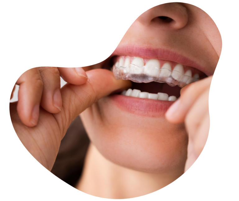Teeth Retainers | WeSmile Dental Care