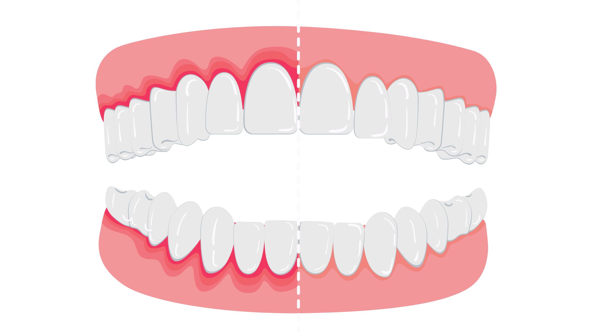 What causes gum diseases & how to treat them?