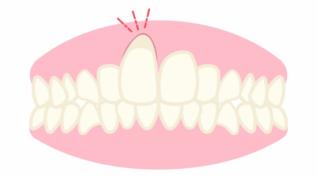 What causes gum diseases & how to treat them?