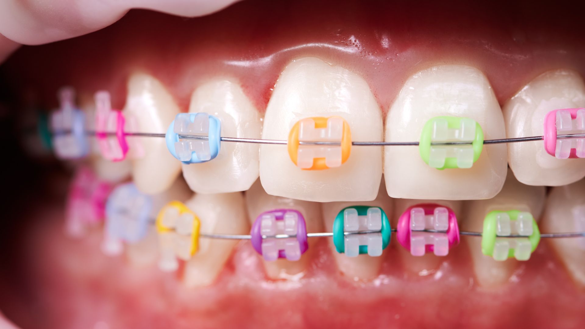 Braces Colours: Adding a Splash of Personality to Your Smile - WeSmile ...