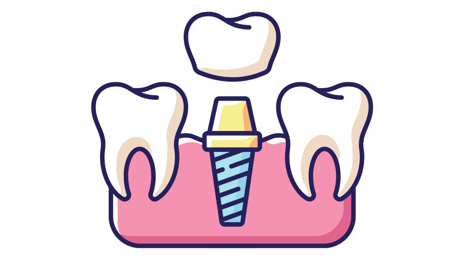 Teeth gaps: A complete guide - WeSmile Dental