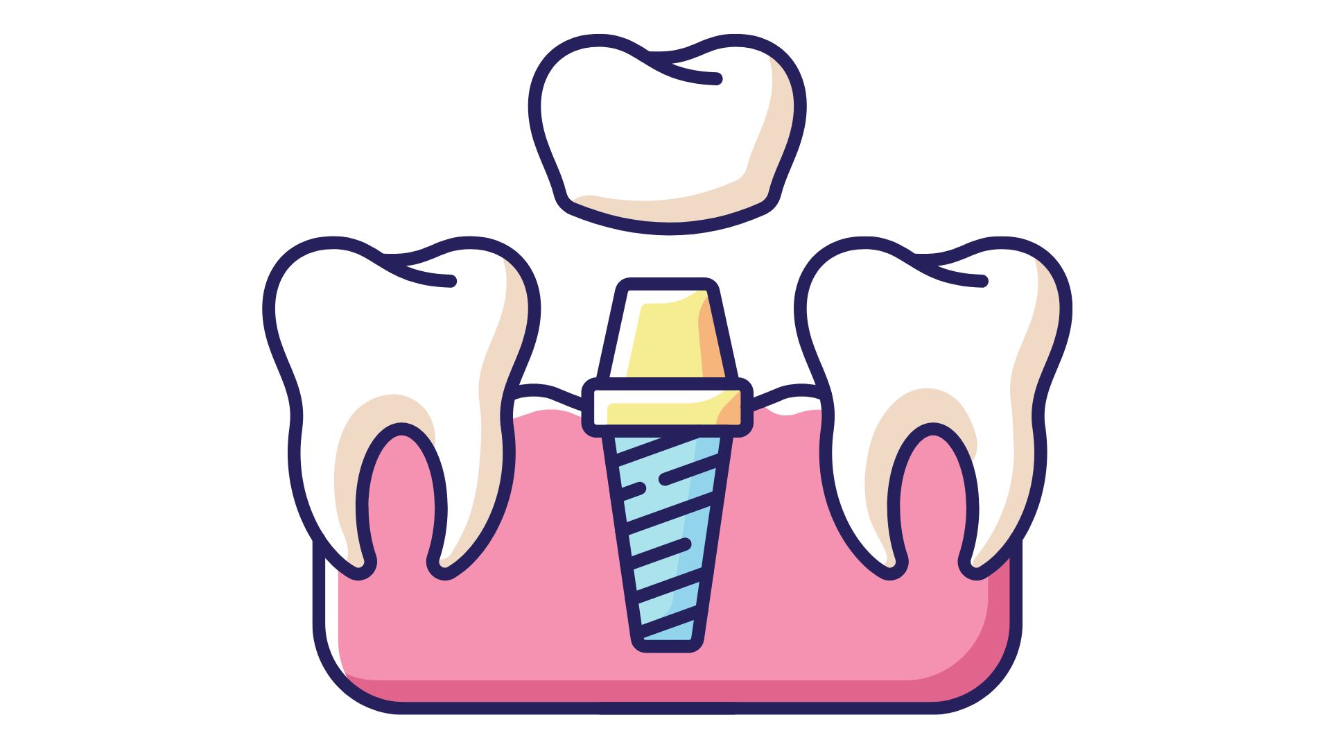 Teeth gaps: A complete guide - WeSmile Dental