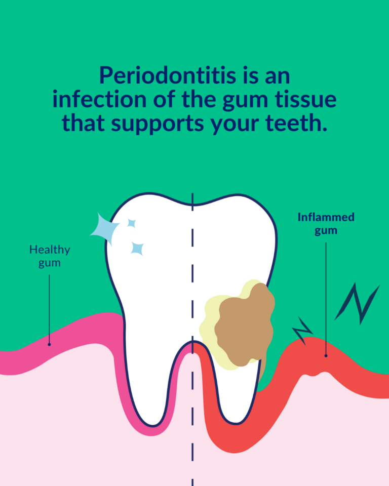 What is periodontitis & how to treat it? | WeSmile Dental
