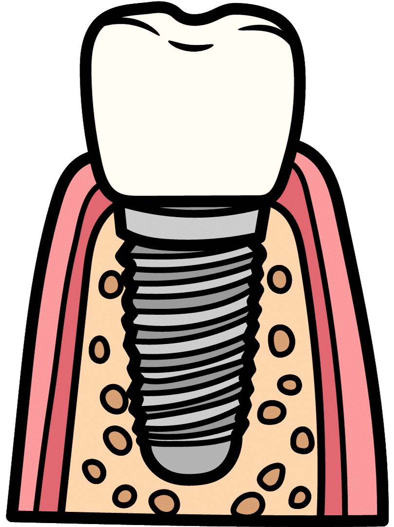 Sinus lifts: An essential for dental implants | WeSmile Dental