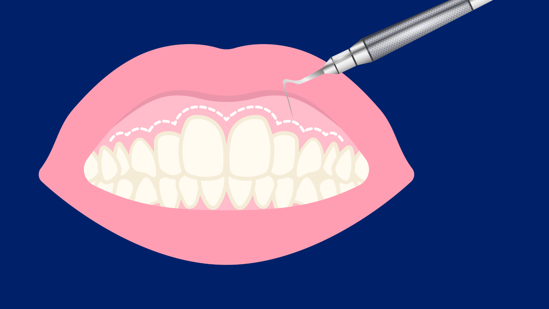 Gum grafts: Nurturing healthy smiles Gum grafts: Nurturing healthy smiles