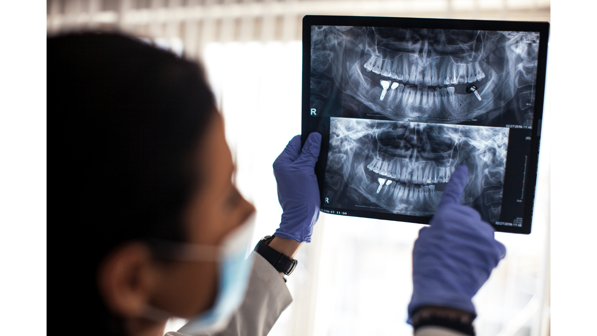 Sinus lifts: An essential for dental implants | WeSmile Dental