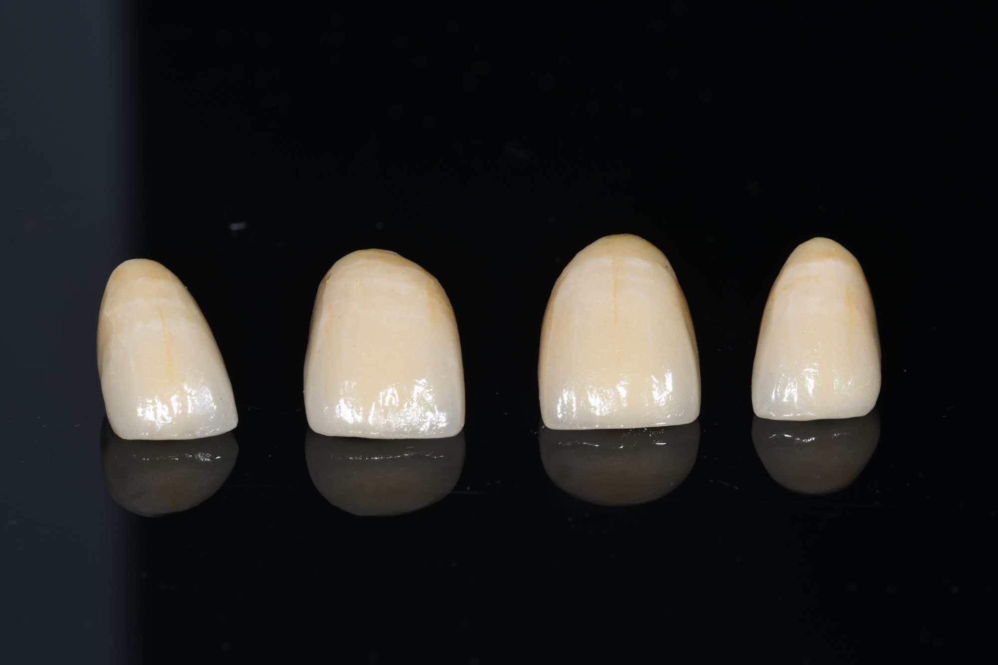 Ceramic Veneers | WeSmile Dental Care
