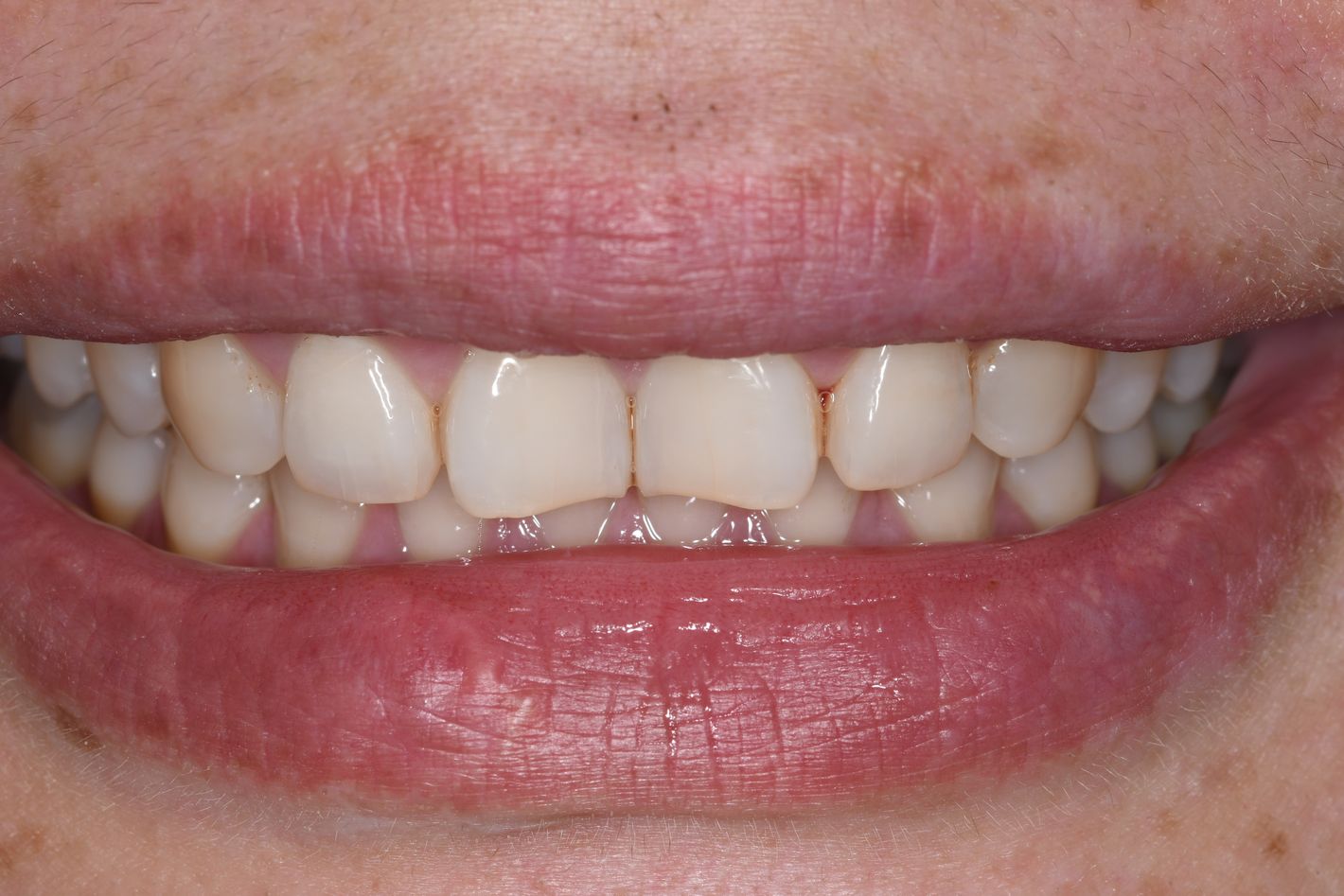 Ceramic Veneers | WeSmile Dental Care