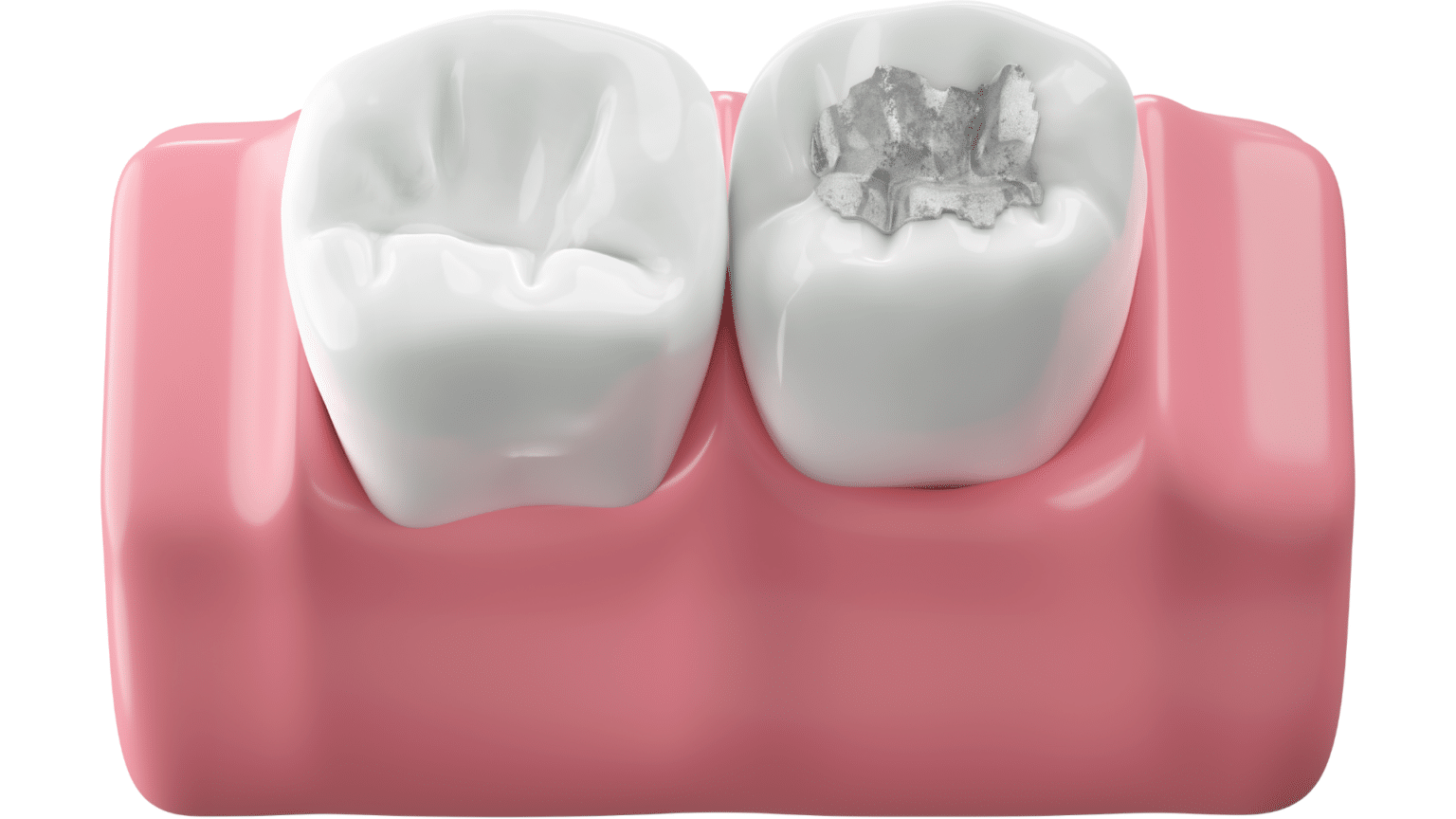 All You Need to Know About Amalgam Fillings | WeSmile Dental Care