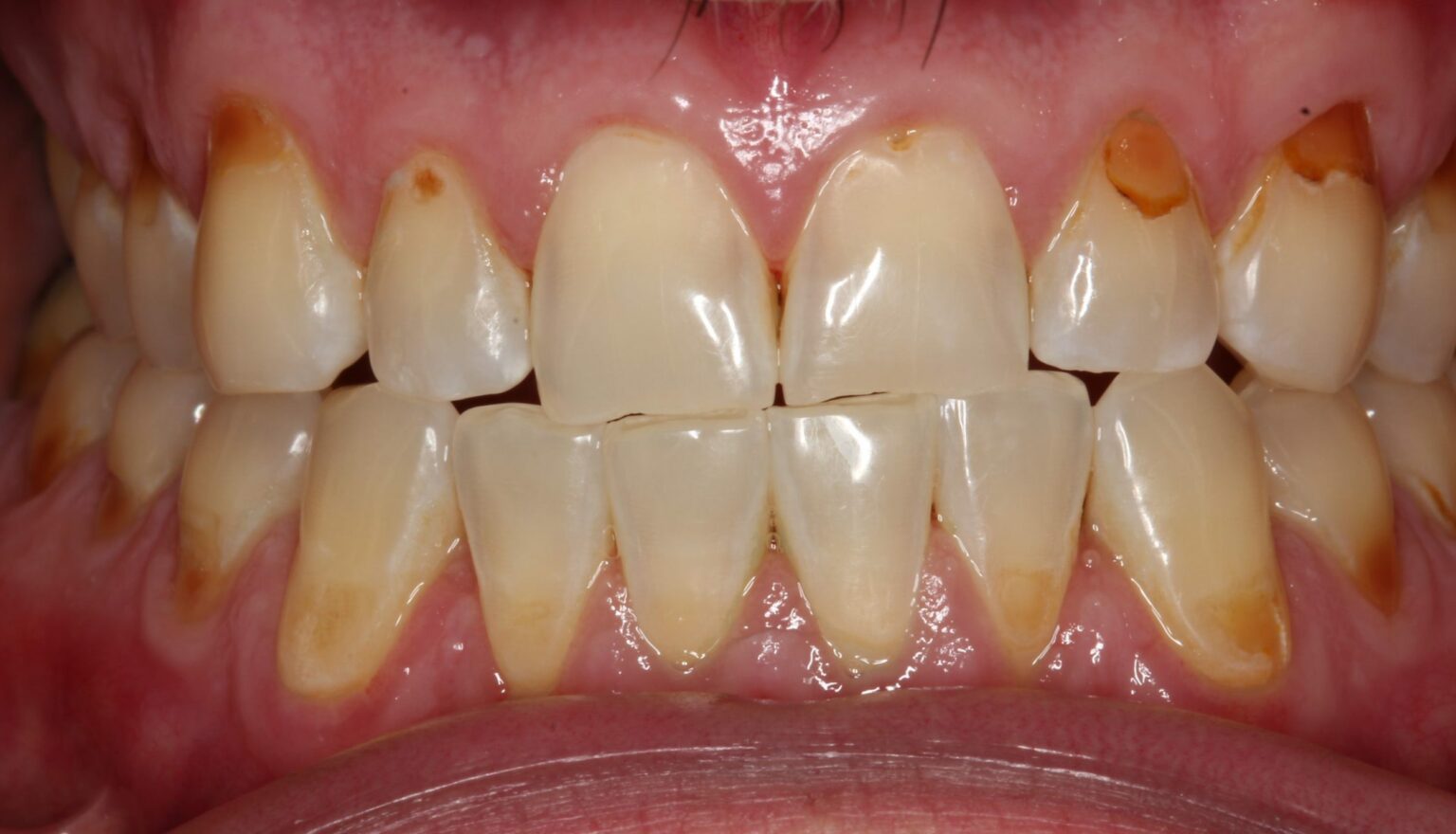 Teeth Erosion & Tooth Wear Management | WeSmile Dental Care