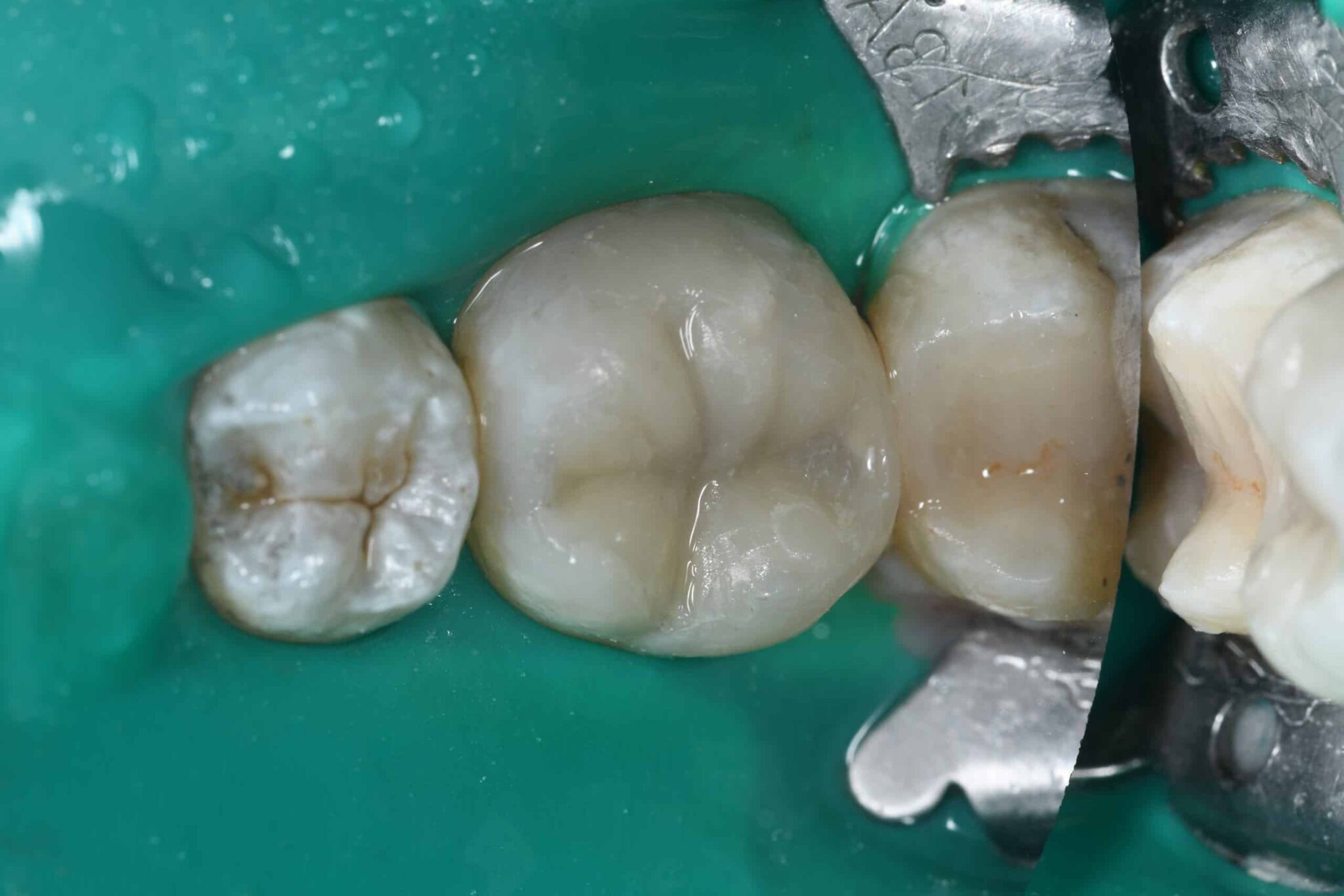 All You Need to Know About Amalgam Fillings | WeSmile Dental Care
