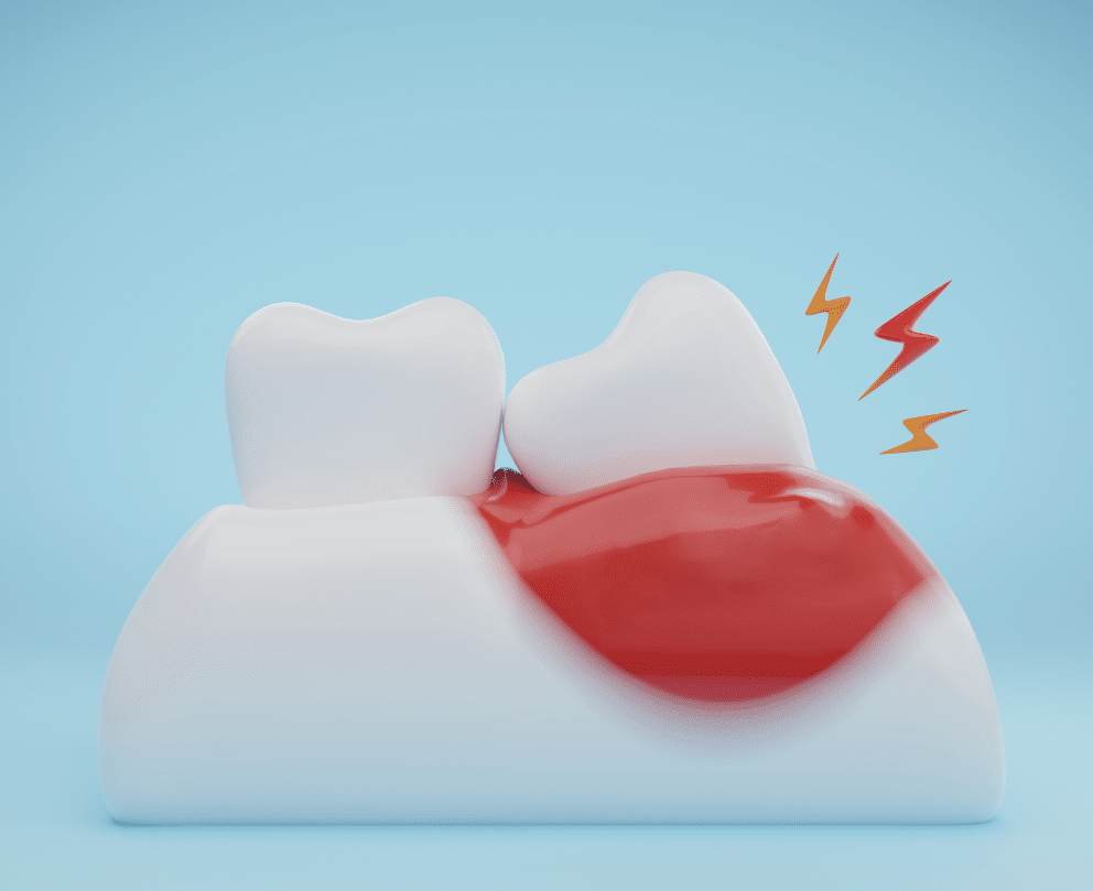 Pericoronitis: Swollen gums at wisdom tooth, what do I do?