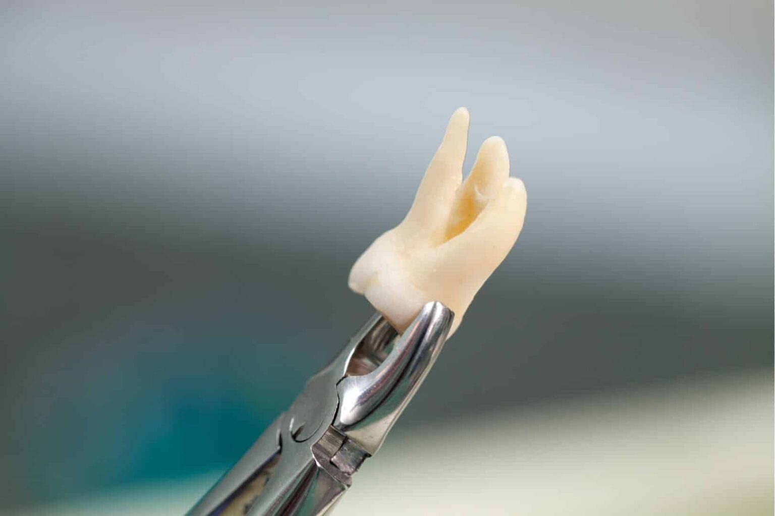 Wisdom teeth X-ray - What is it for? | WeSmile Dental Care